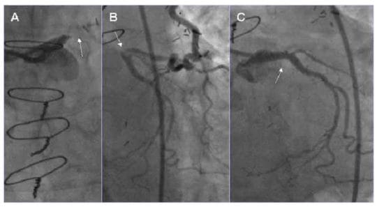 Ventricular Fibrillation (VF) - AF-ABLATION