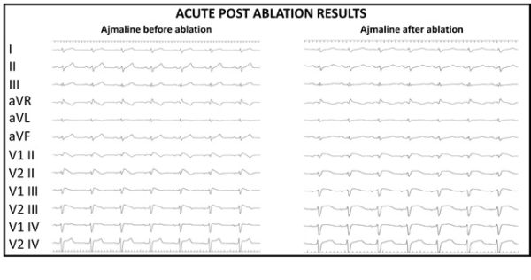 Substrate Ablation of Brugada Syndrome - AF-ABLATION