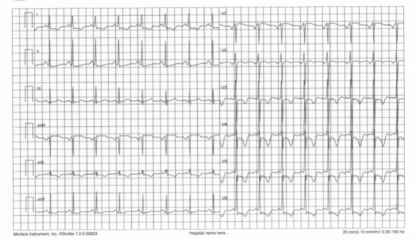 Hypertrophic Cardiomyopathy - AF-ABLATION