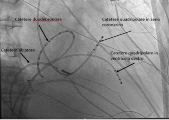 Atrial Flutter (AFL) Ablation - AF-ABLATION