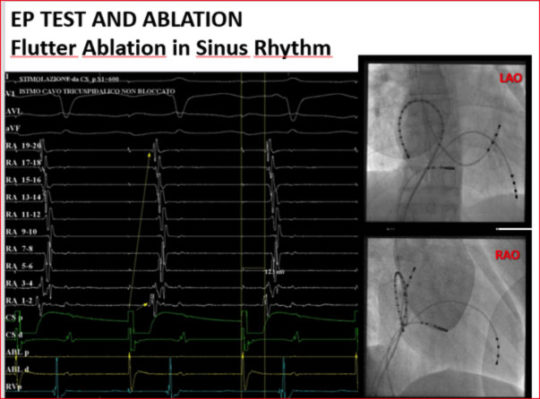 Atrial Flutter (AFL) Ablation - AF-ABLATION