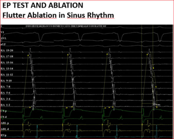 Atrial Flutter (AFL) Ablation - AF-ABLATION