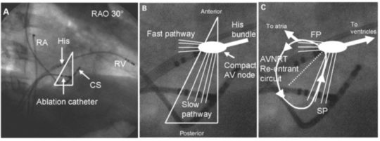 Atrioventricular Nodal Reentrant Tachycardia (AVNRT) Ablation - AF-ABLATION