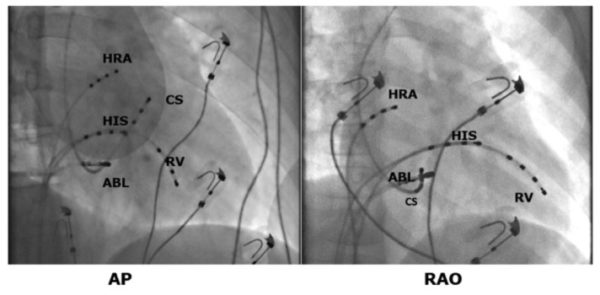 Atrioventricular Nodal Reentrant Tachycardia (AVNRT) Ablation - AF-ABLATION