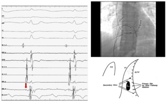 Atrioventricular Nodal Reentrant Tachycardia (AVNRT) Ablation - AF-ABLATION