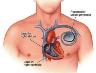 Impianto Pacemaker (PMK) - AF-ABLATION