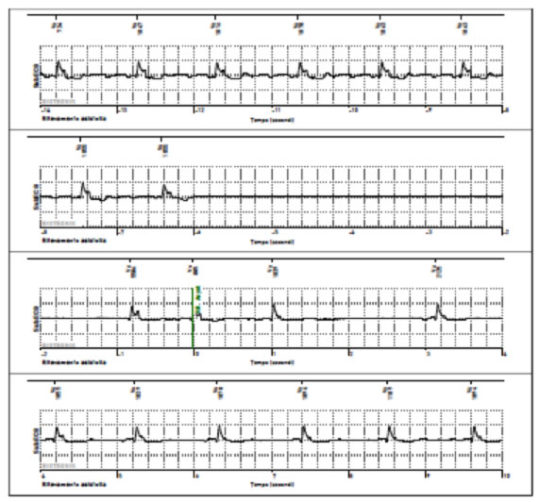 Implantable Loop Recorder - AF-ABLATION