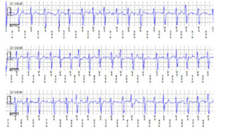 Implantable Loop Recorder - AF-ABLATION