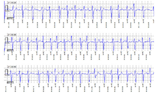 Implantable Loop Recorder - AF-ABLATION
