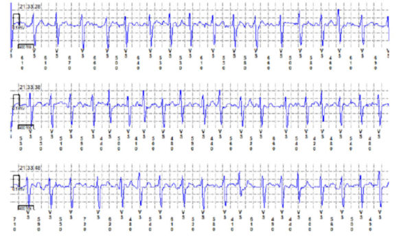 Implantable Loop Recorder - AF-ABLATION