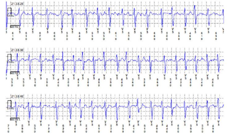 Implantable Loop Recorder - AF-ABLATION