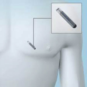 Implantable Loop Recorder - AF-ABLATION