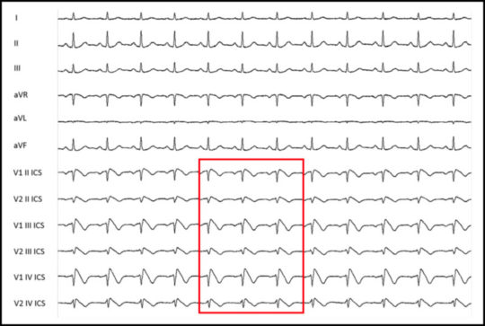Sindrome di Brugada (SdB) - AF-ABLATION