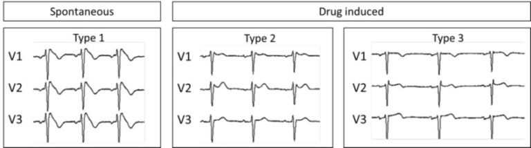 Sindrome di Brugada (SdB) - AF-ABLATION