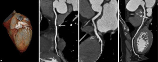 Coronary AngioTAC - AF-ABLATION