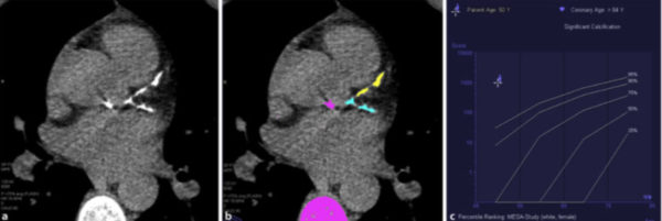 Coronary AngioTAC - AF-ABLATION