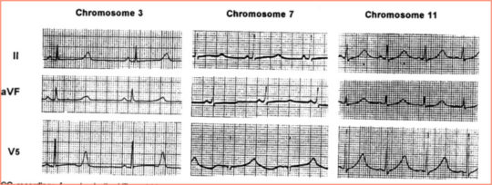 Sindrome del QT lungo (LQTS) - AF-ABLATION