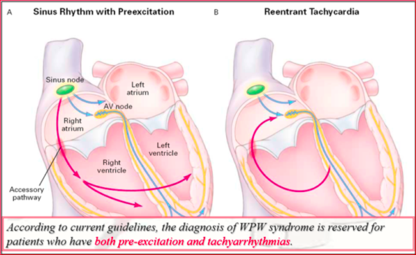 Atrio-Ventricular Abnormalities (WPW) Ablation - AF-ABLATION
