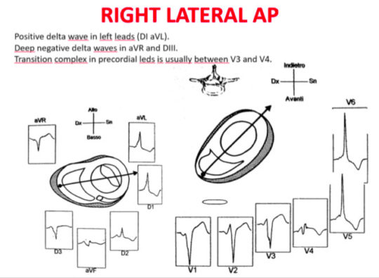 Wolff-Parkinson White Syndrome (WPW): Atrio-ventricular Reentry ...