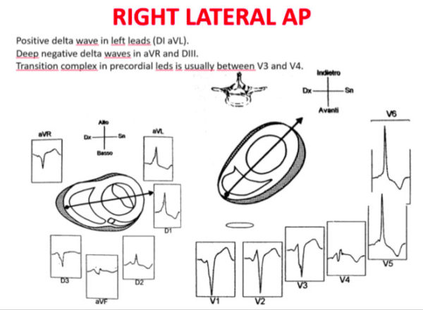 Wolff-Parkinson White Syndrome (WPW): Atrio-ventricular Reentry ...