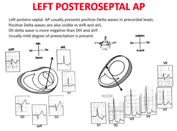 Wolff-Parkinson White Syndrome (WPW): Atrio-ventricular Reentry ...