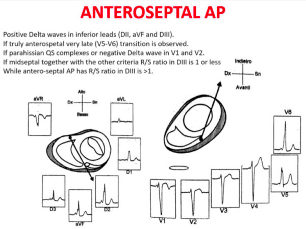 Wolff-Parkinson White Syndrome (WPW): Atrio-ventricular Reentry ...