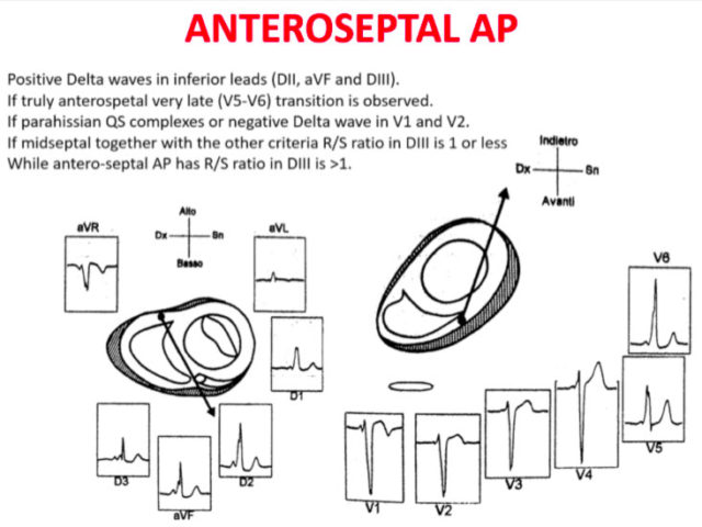 Wolff-Parkinson White Syndrome (WPW): Atrio-ventricular Reentry ...