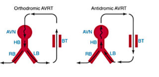 Atrio-Ventricular Abnormalities (WPW) Ablation - AF-ABLATION