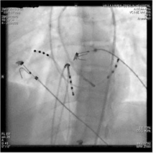 Atrio-Ventricular Abnormalities (WPW) Ablation - AF-ABLATION