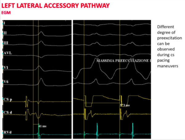 Atrio-Ventricular Abnormalities (WPW) Ablation - AF-ABLATION
