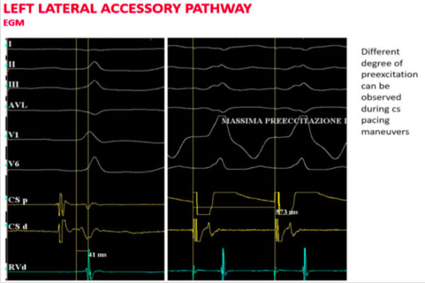 Atrio-Ventricular Abnormalities (WPW) Ablation - AF-ABLATION