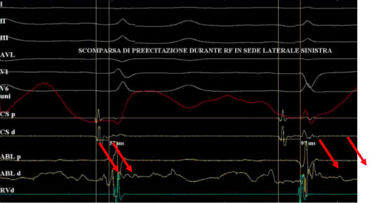 Atrio-Ventricular Abnormalities (WPW) Ablation - AF-ABLATION