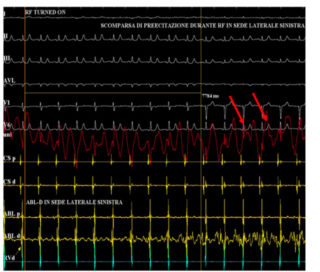 Atrio-Ventricular Abnormalities (WPW) Ablation - AF-ABLATION
