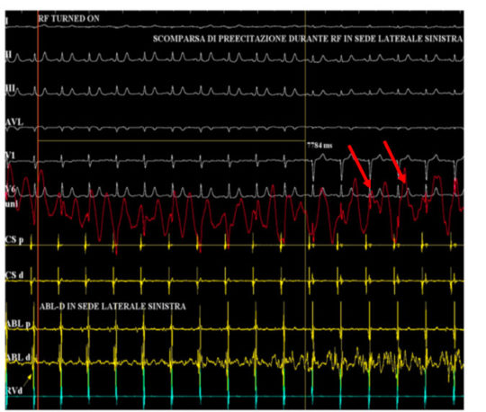 Atrio-Ventricular Abnormalities (WPW) Ablation - AF-ABLATION