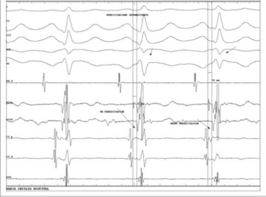 Wolff-Parkinson White Syndrome (WPW): Atrio-ventricular Reentry ...