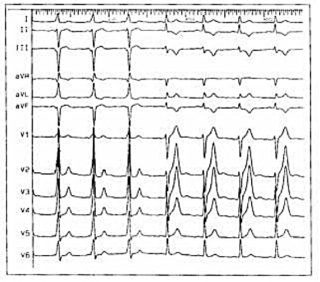 Wolff-Parkinson White Syndrome (WPW): Atrio-ventricular Reentry ...