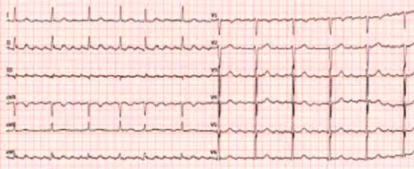 Flutter atriale (FLA) - AF-ABLATION