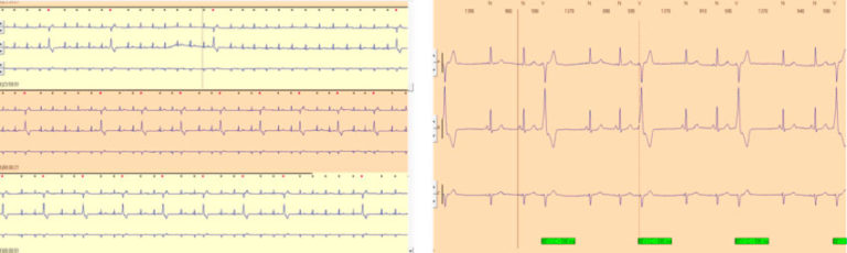 Ventricular Extrasystoles (PVC) - AF-ABLATION