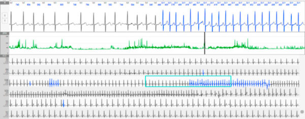 Atrial tachycardias - AF-ABLATION