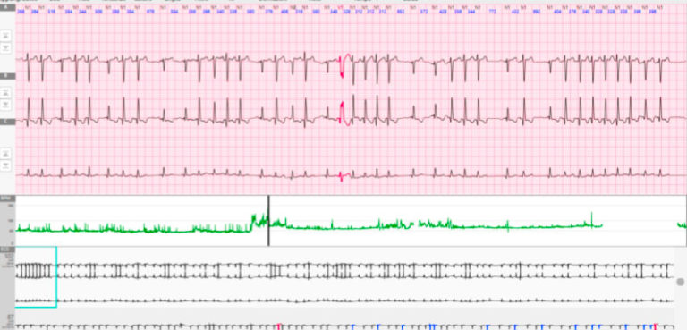 Tachicardia atriale (TA) - AF-ABLATION