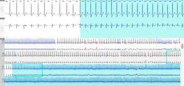 Tachicardia da rientro nodale (TRN) - AF-ABLATION