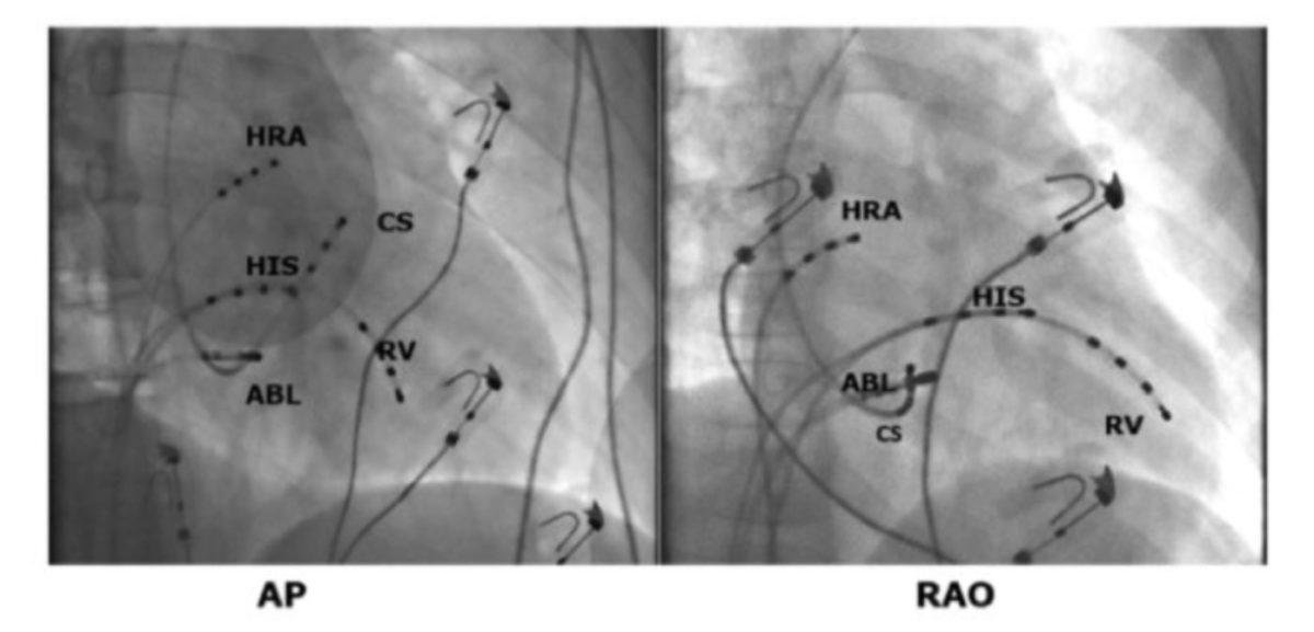Ablation of Atrial Tachycardia - AF-ABLATION